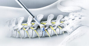 Bandscheibenvorfall: Minimalinvasive Operation | PD Dr. Leu (Hirslanden)
