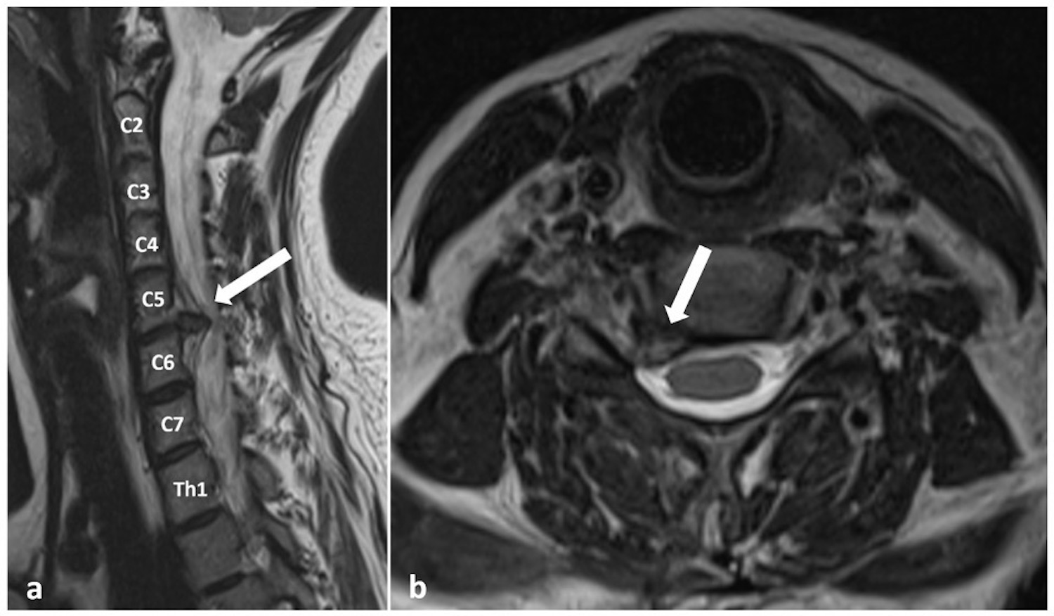Bandscheibenvorfall an der Halswirbelsäule (Diskushernie) | Dr. Burkhardt