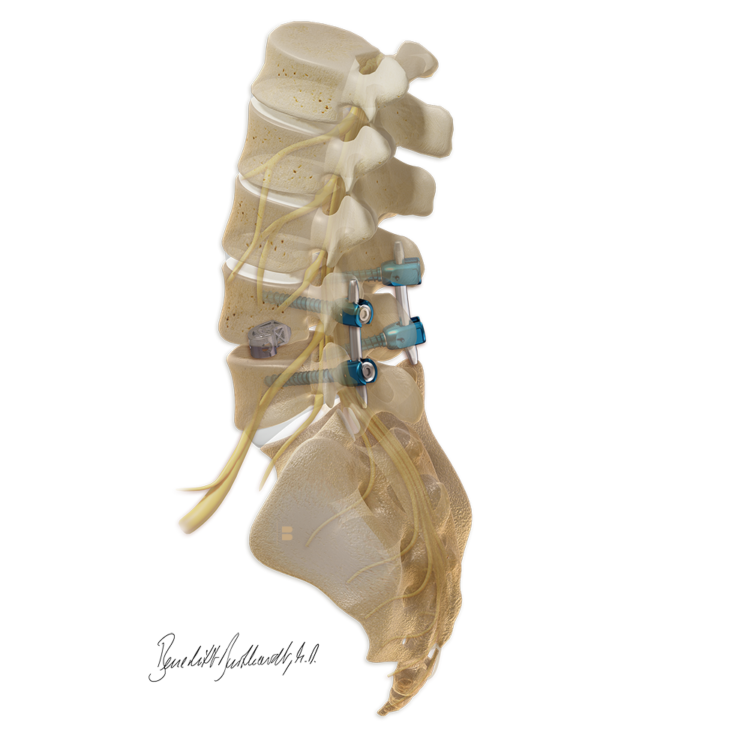 Rückenschmerzen - Wirbelsäulenzentrum | Spine Center Zürich - WSC | PD ...